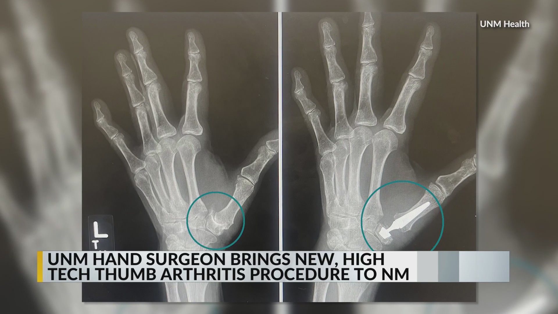 UNM hand surgeon offering new way to help those suffering from thumb ...