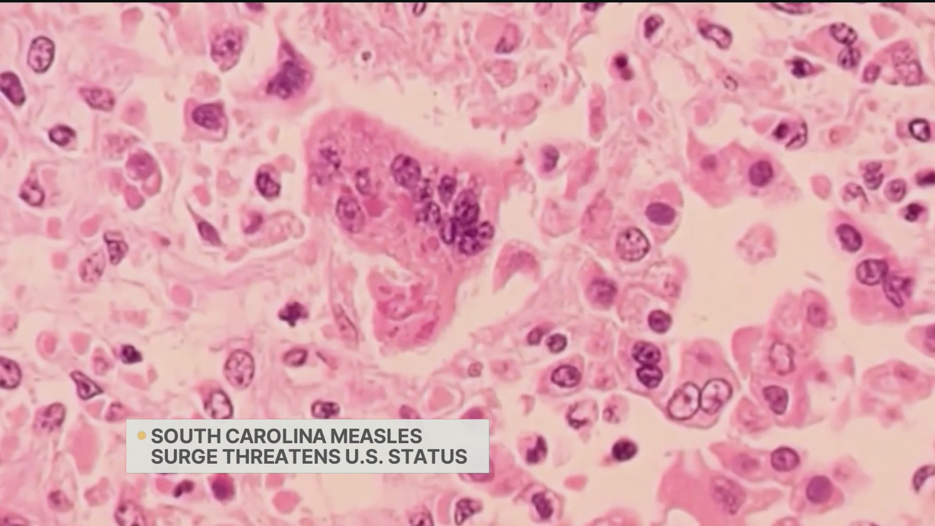 SC Measles surge threatens US status – CW39 Houston