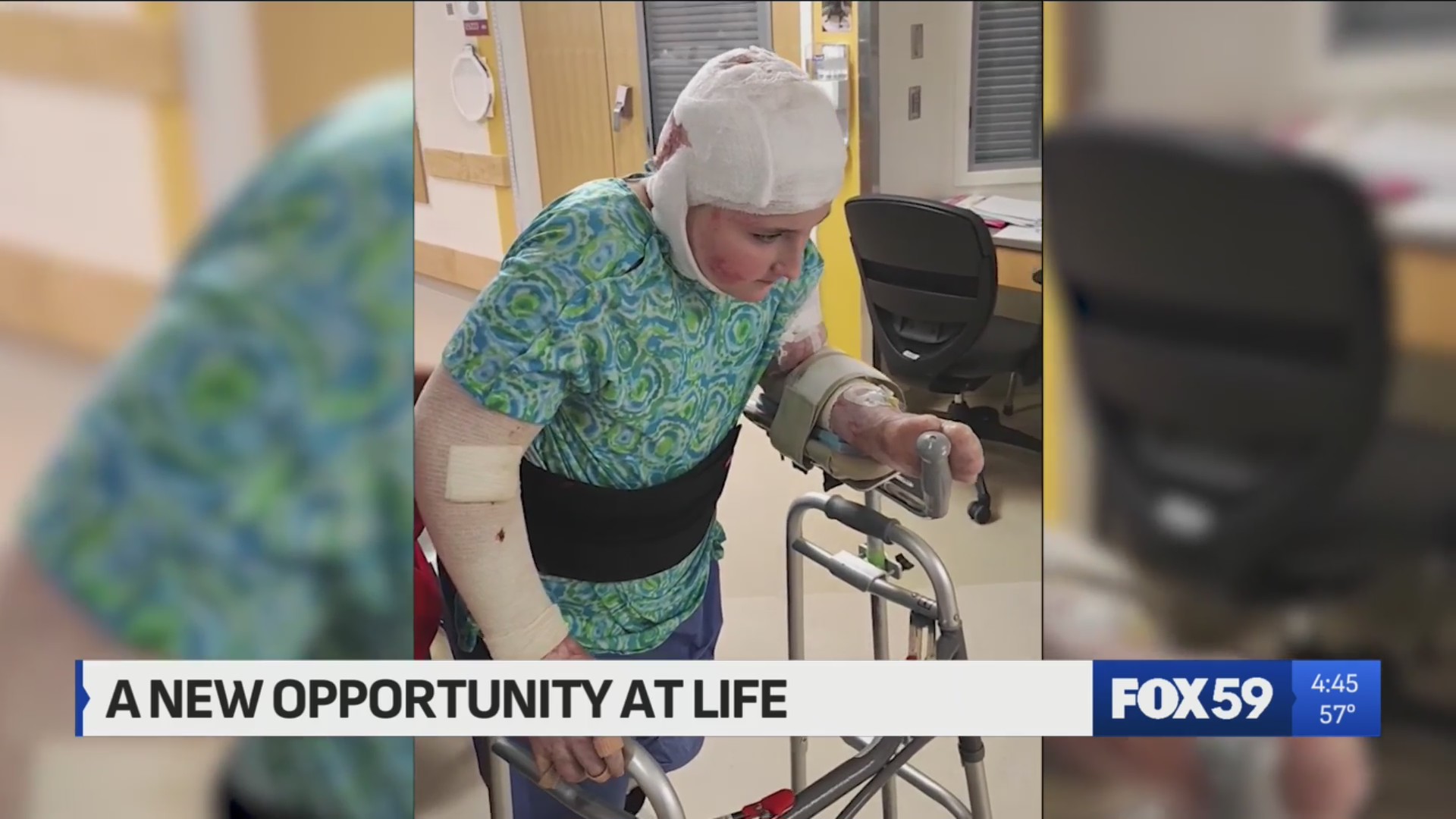 Teen burn victim survives near-fatal injuries – Fox 59