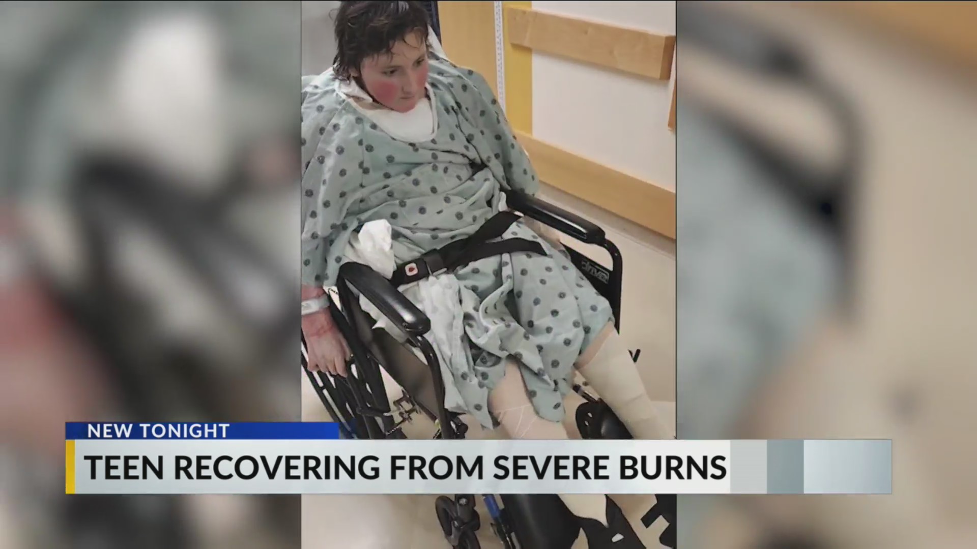 Teen burn victim survives near-fatal injuries – Fox 59