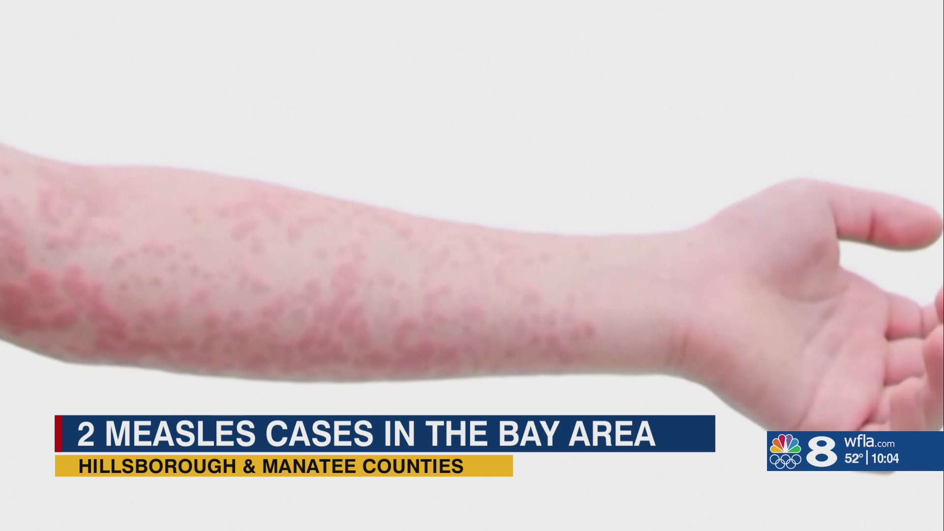 ‘Measles is one of the most highly contagious diseases’, doctors warn ...