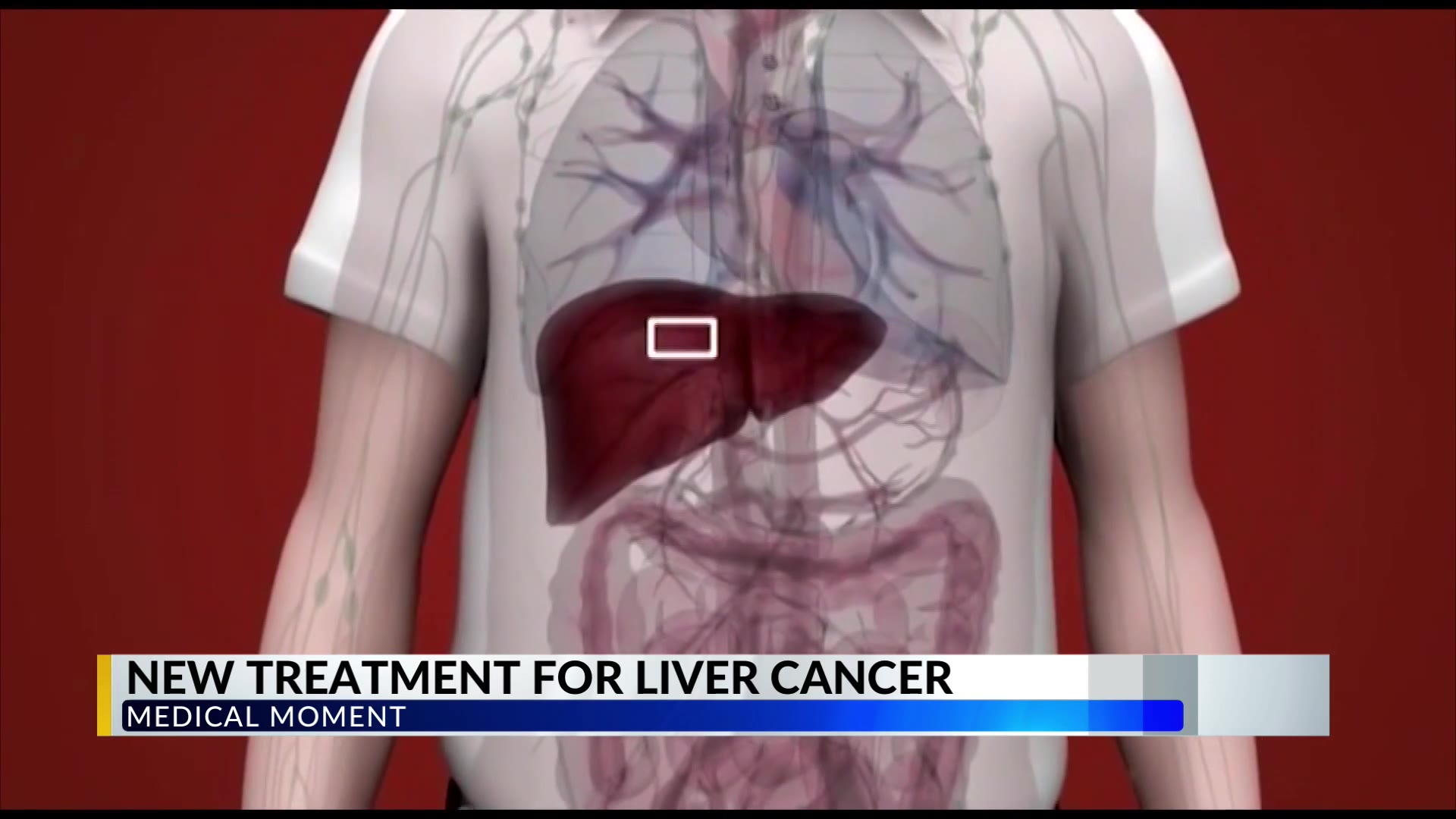 Medical Moment: New Treatment for Liver Cancer with Natalie Bath of USA ...