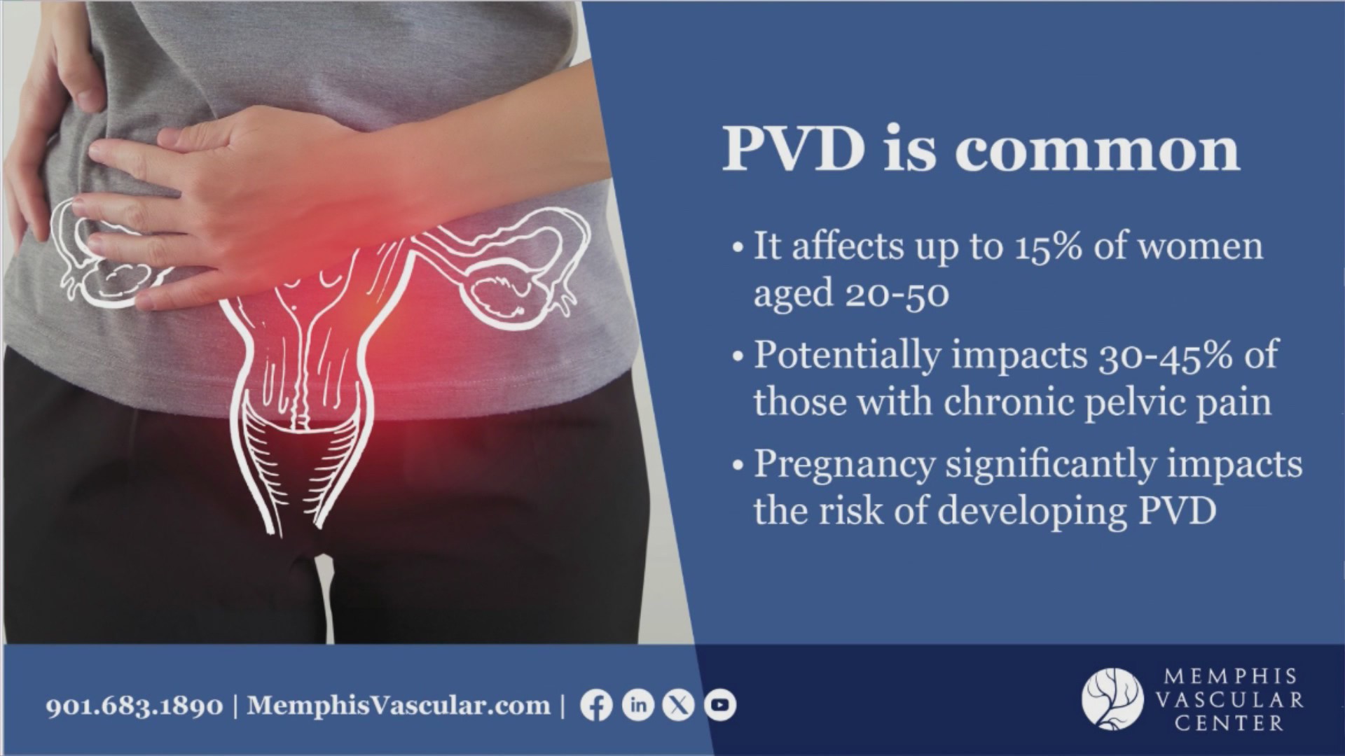 Understanding pelvic venous disease – WREG.com