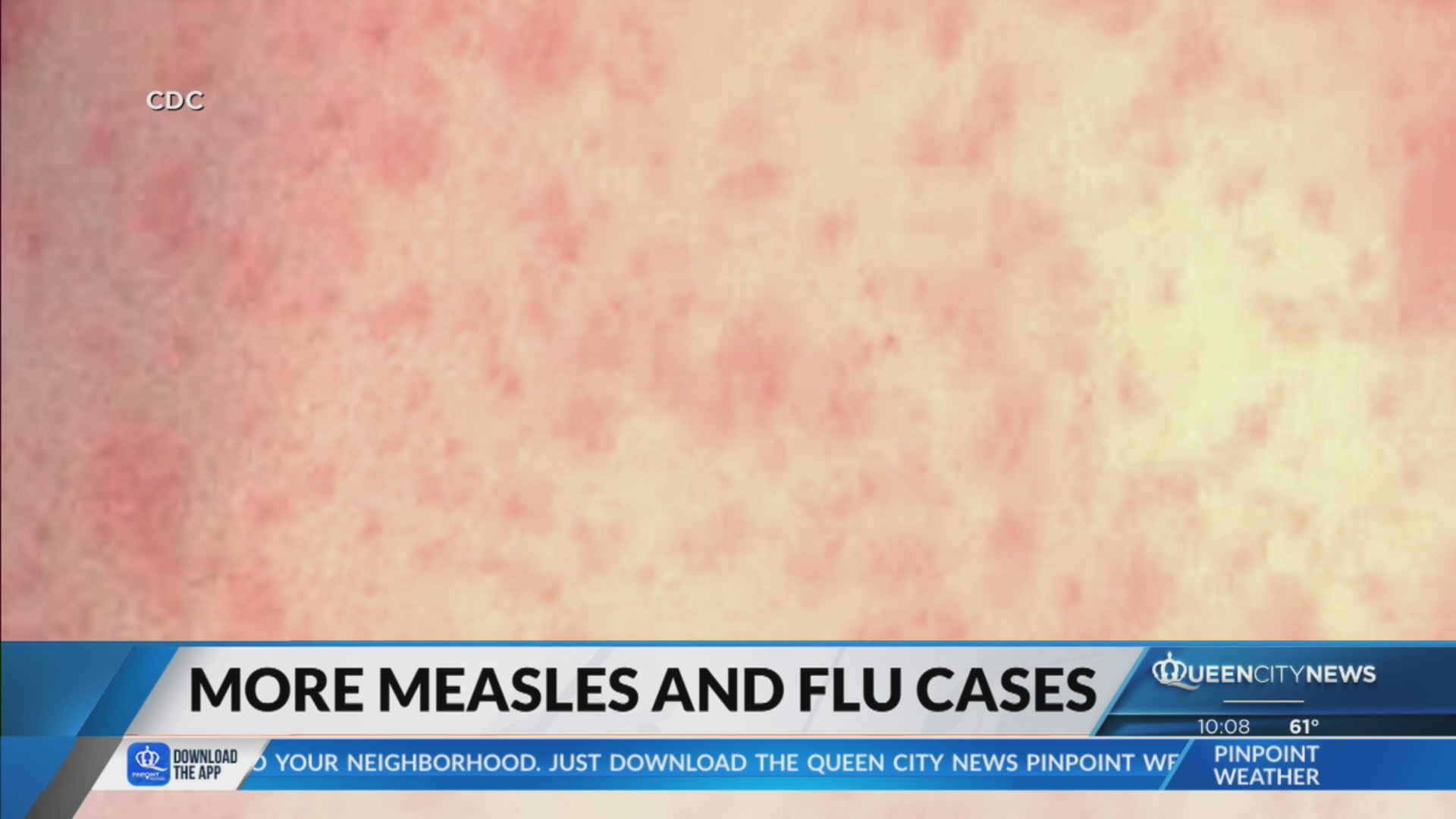 Measles cases continue to creep into western NC – Queen City News